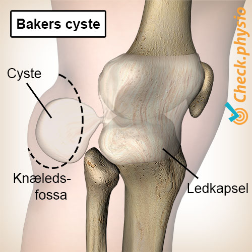 Årsag, symptomer & behandling | Bakers cyste - Physiocheck.dk