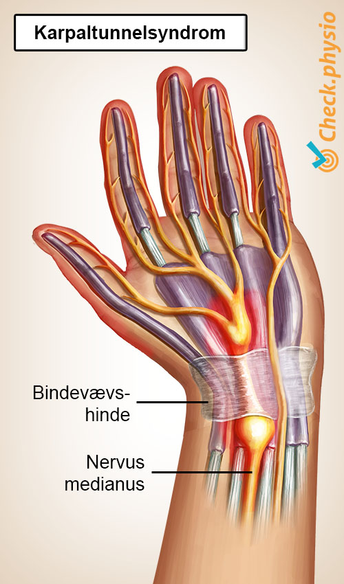 Karpaltunnelsyndrom | Årsag, symptomer & behandling
